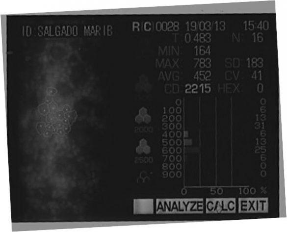 Caso Catarata Distrofia de Fuchs | Alaccsa-R