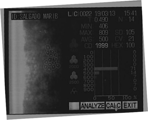 Caso Catarata Distrofia de Fuchs | Alaccsa-R