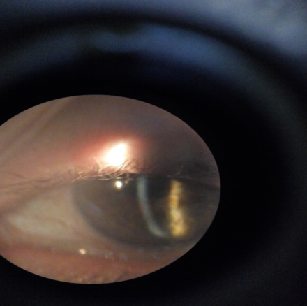 Editorial Catarata: Actualización en el uso de bioadhesivos | Alaccsa-R